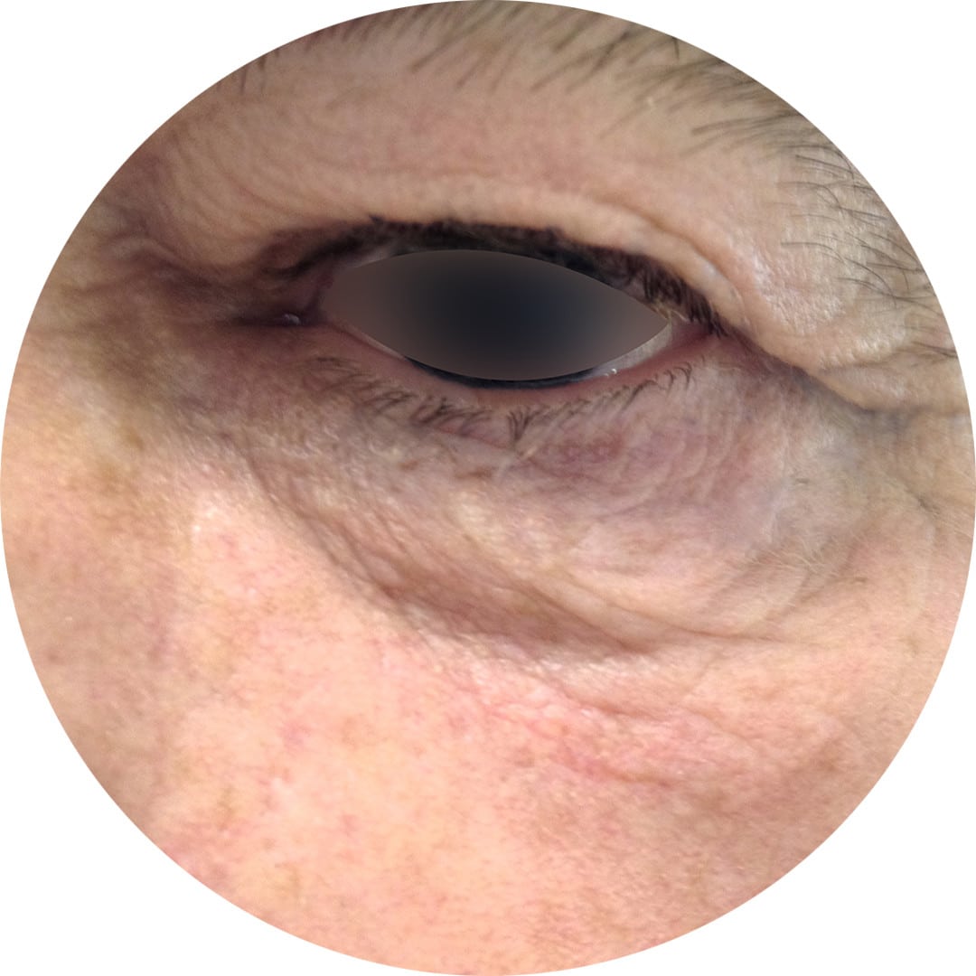 Blefaroplastika - Juventina clinic