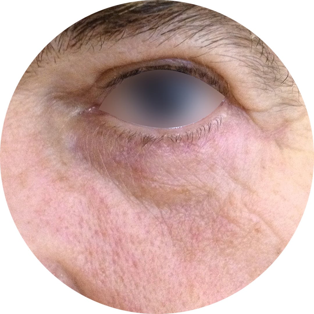 Blefaroplastika - Juventina clinic