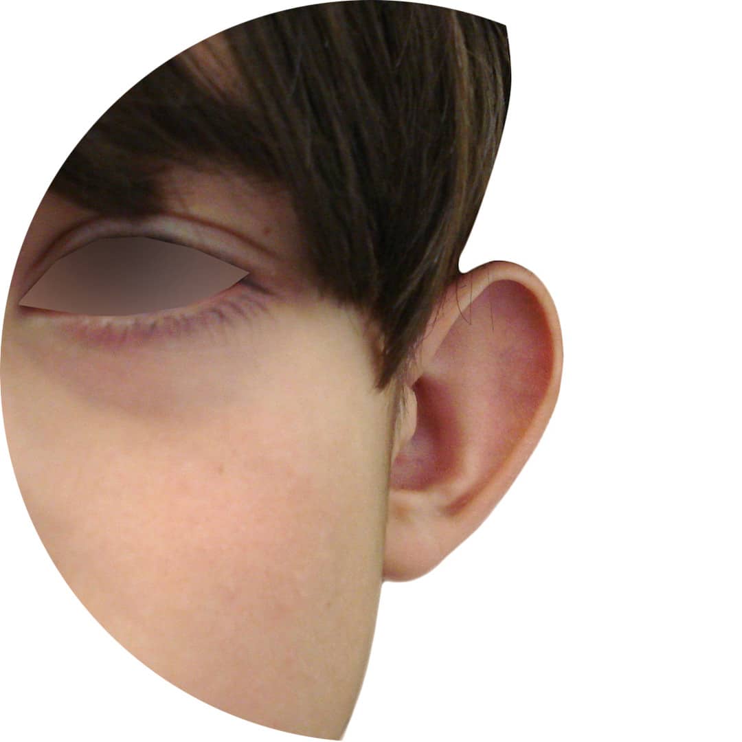 Otoplastika - Juventina clinic